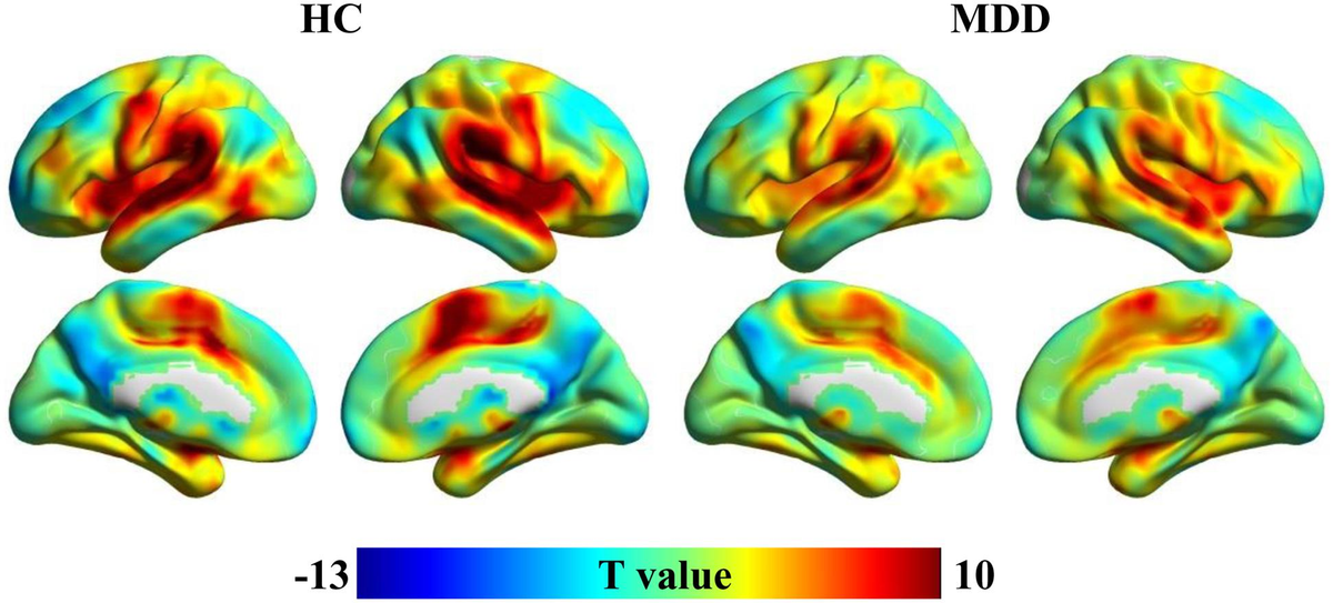 Frontiers | Abnormal Global Functional Connectivity Patterns in ...