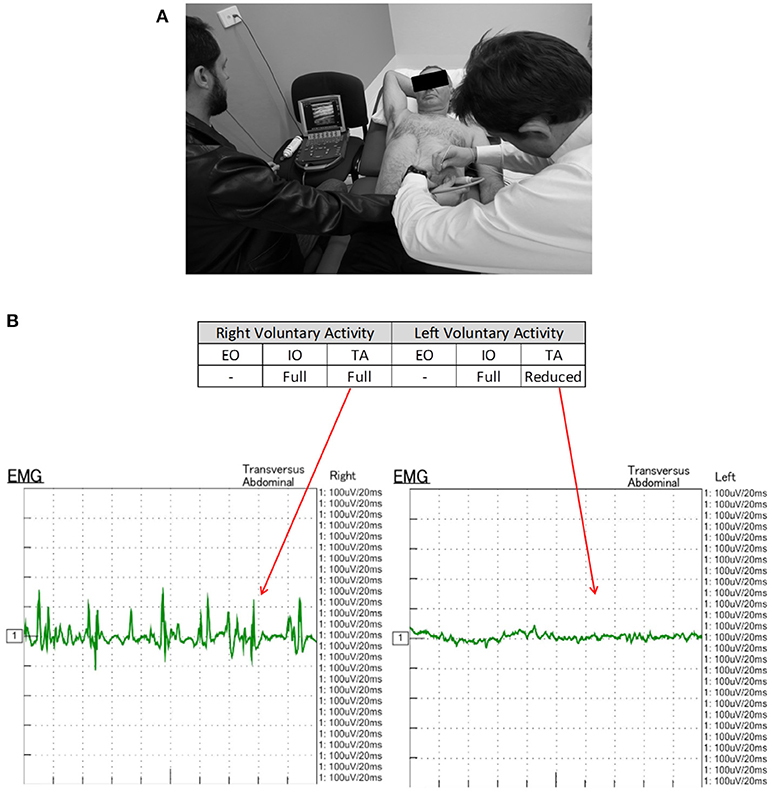 Frontiers | Limitations of Electromyography in the Assessment of ...