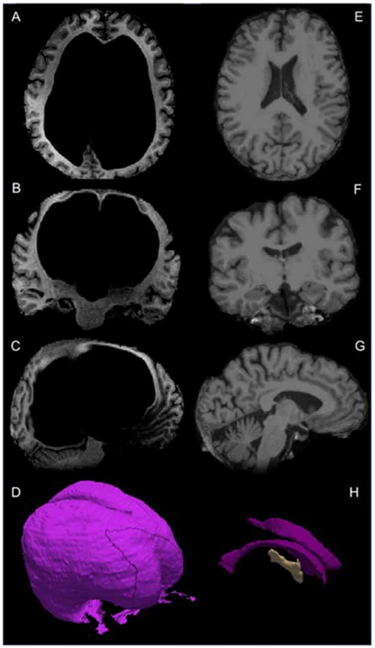 Frontiers | Volumetric MRI Analysis of a Case of Severe Ventriculomegaly