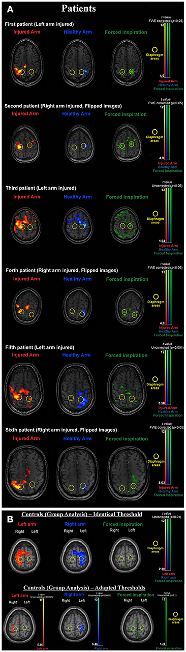 Frontiers | Peripheral Nervous System Reconstruction Reroutes Cortical ...