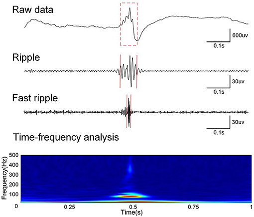 Frontiers | Automated Detection of High-Frequency Oscillations in Epilepsy Based on a ...