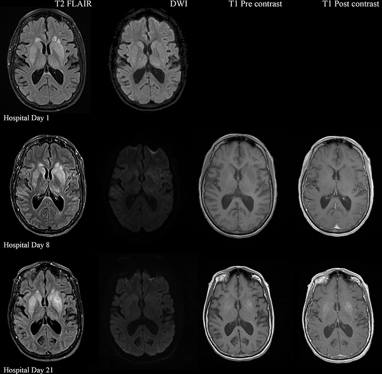 Frontiers | Acute Seroconversion of Eastern Equine Encephalitis ...