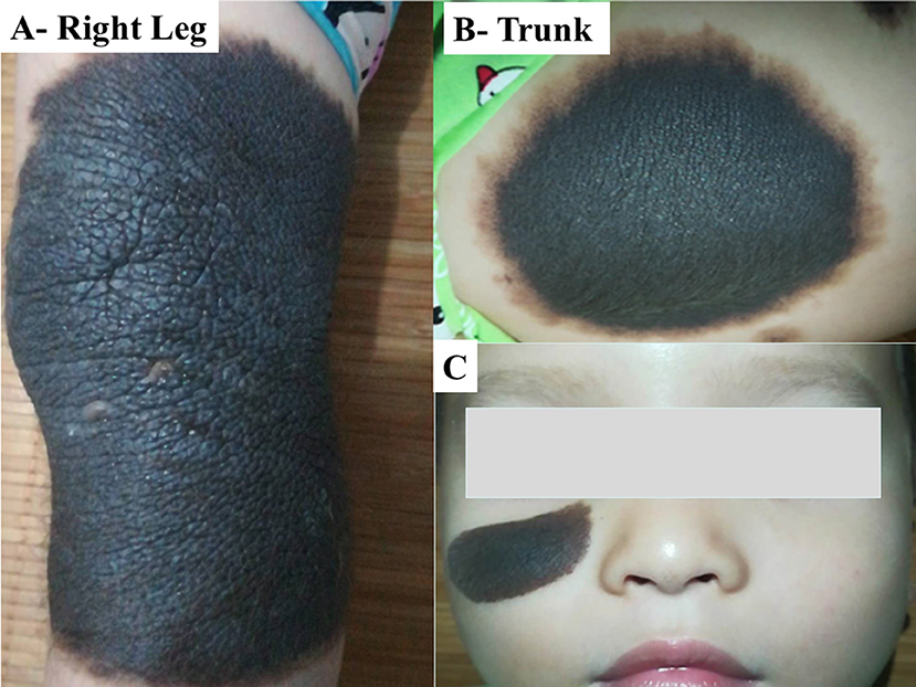 Frontiers | Neurocutaneous Melanosis in Association With Large ...