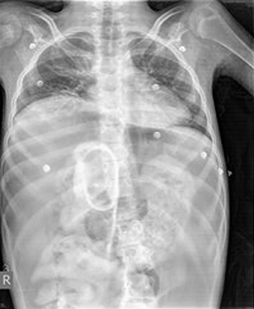 Frontiers | Gastric Necrosis and Perforation Following Massive Gastric ...