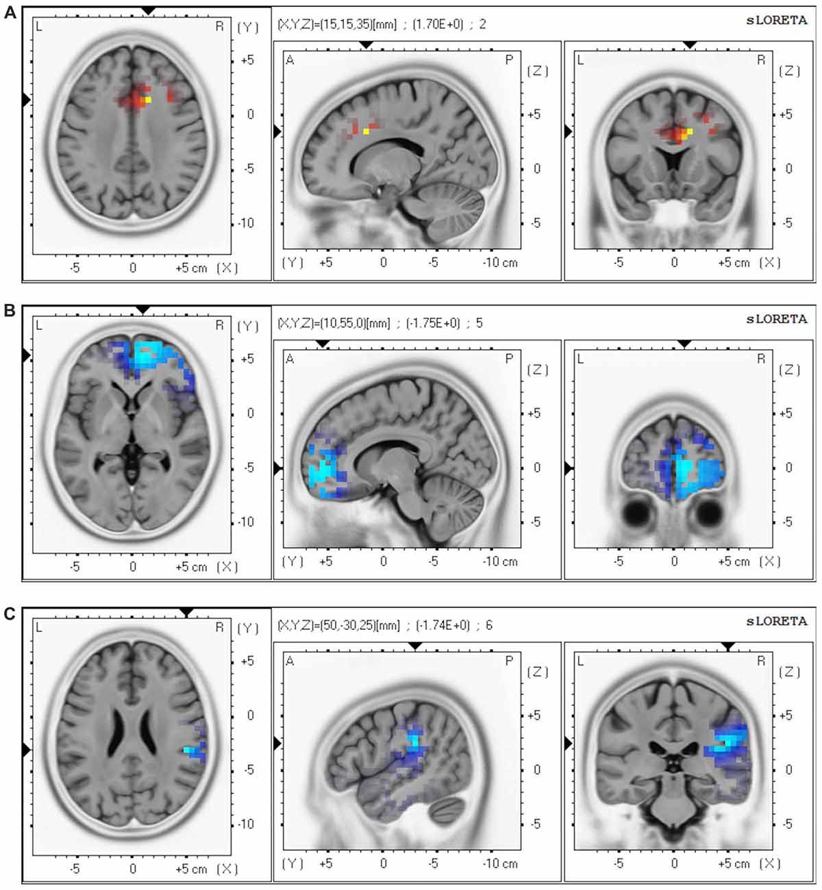 Frontiers | Electroconvulsive Therapy Modulates Resting-State EEG ...