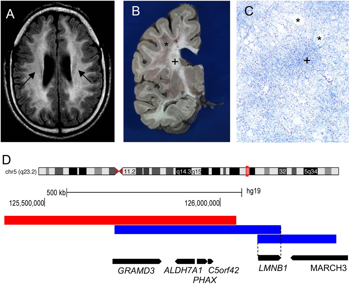 Frontiers | Autosomal Dominant Leukodystrophy: A Disease of the Nuclear ...