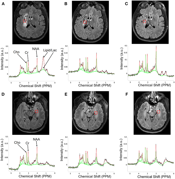 Frontiers | Serial Cerebral Metabolic Changes in Patients With Ischemic ...