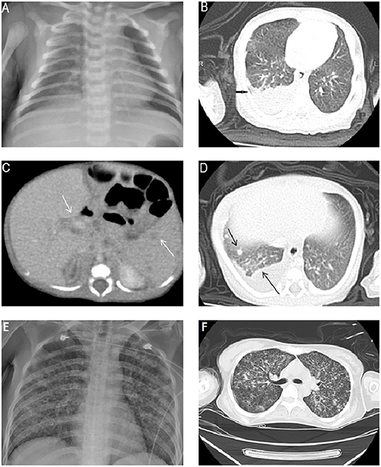 Frontiers | Congenital Tuberculosis in a Neonate: A Case Report and ...