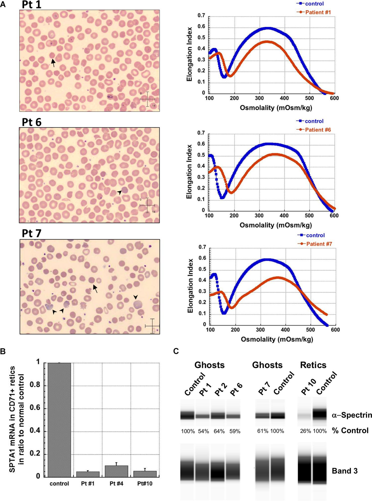Frontiers | The Spectrum of SPTA1-Associated Hereditary Spherocytosis