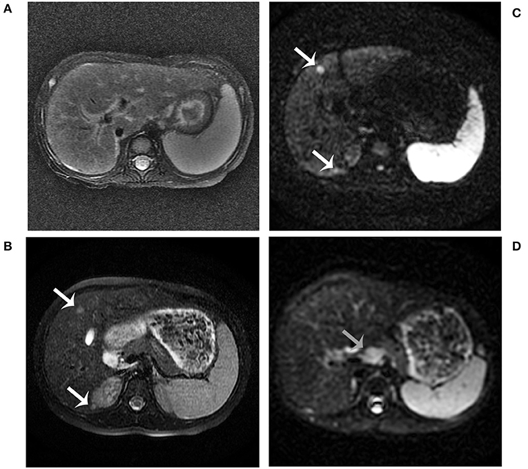 Frontiers | A Case Report: Can Citrin Deficiency Lead to Hepatocellular ...