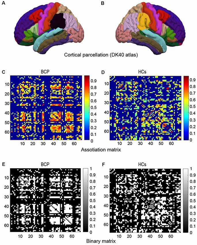 Frontiers | Abnormal Gray Matter Structural Covariance Networks in Children With Bilateral ...