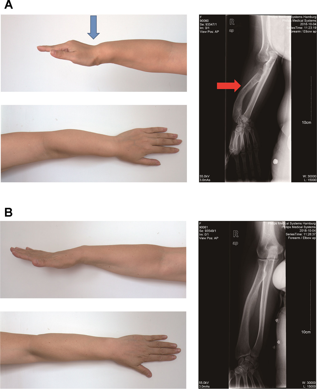 Frontiers | Heterozygous Deletion of the SHOX Gene Enhancer in two ...