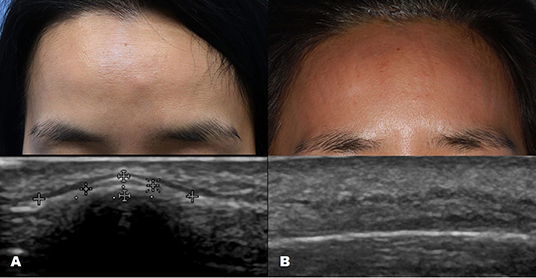 Frontiers | Skin Imaging Using Ultrasound Imaging, Optical Coherence ...