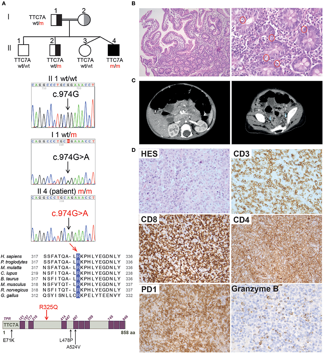 Frontiers | Chronic Intestinal Pseudo-Obstruction and ...