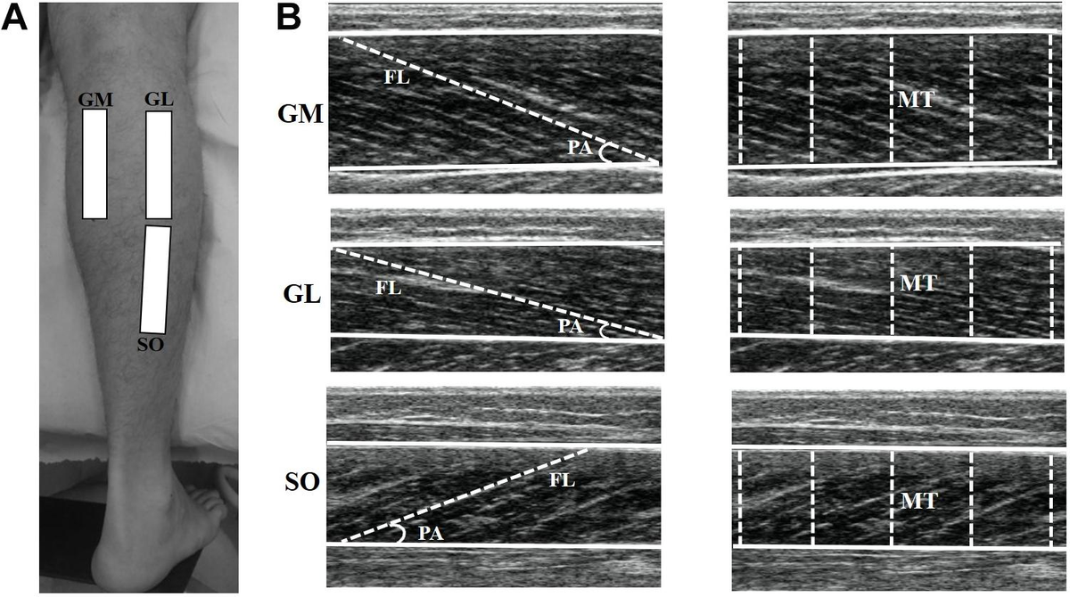Frontiers | Triceps Surae Muscle Architecture Adaptations to Eccentric ...