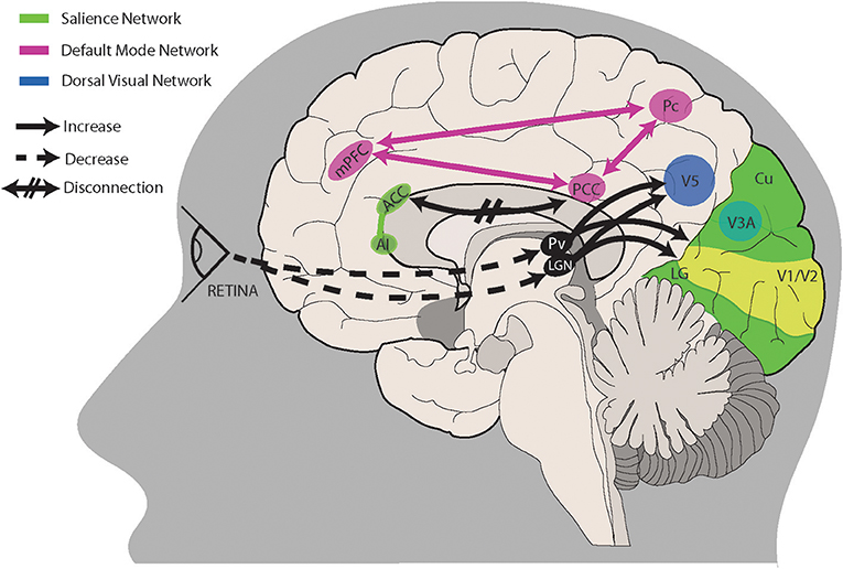 Ocular Migraine Simulation