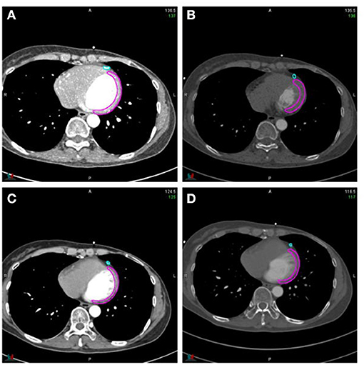 Frontiers | Study on the Effect of 4D-CT Special Reconstruction Images ...