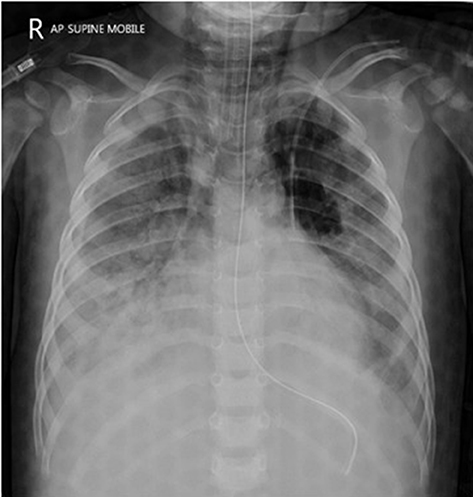 Frontiers | Accidental Pyrethroid Ingestion in Toddler: Near-Fatal ...