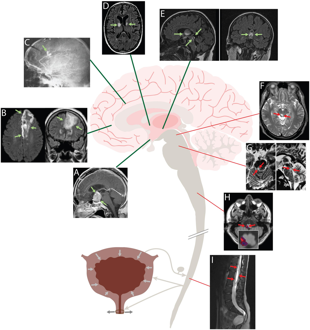 Frontiers | The Brain and the Bladder: Forebrain Control of Urinary (In ...