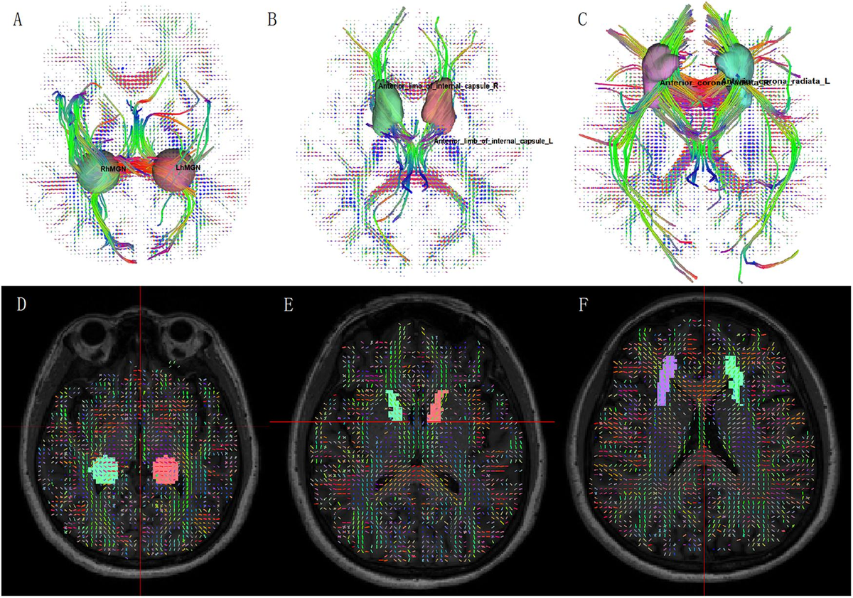 Frontiers | White Matter Abnormalities of Auditory Neural Pathway in ...
