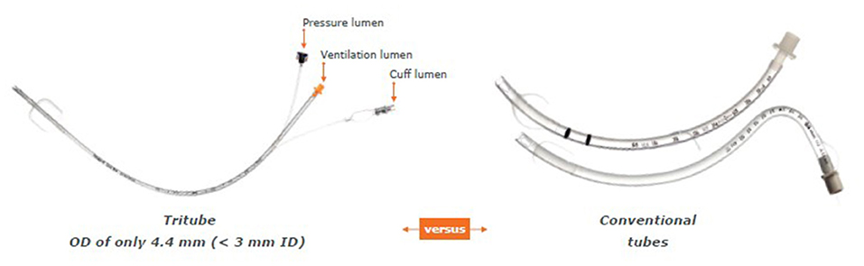 Frontiers | Evone® Flow-Controlled Ventilation During Upper Airway ...