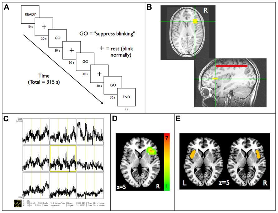 Frontiers | Modulation of functionally localized right insular cortex ...
