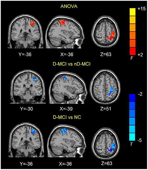 Frontiers | Abnormal Functional Connectivity of the Amygdala in Mild ...