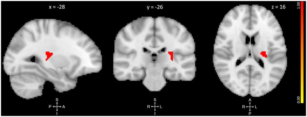 Frontiers | Gray Matter Changes in Adolescents Participating in a ...
