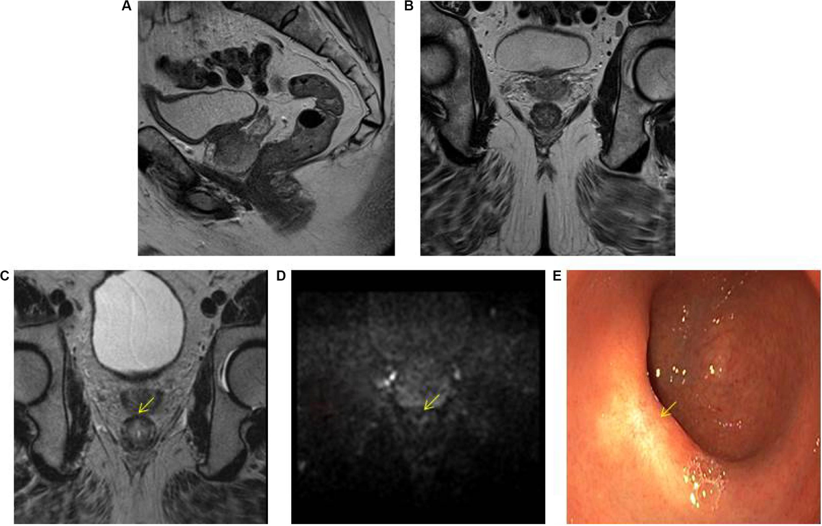 Frontiers | Modern MR Imaging Technology in Rectal Cancer; There Is ...