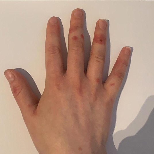 Frontiers | How to Deal With Post-viral Cutaneous Eruptions in the Era ...