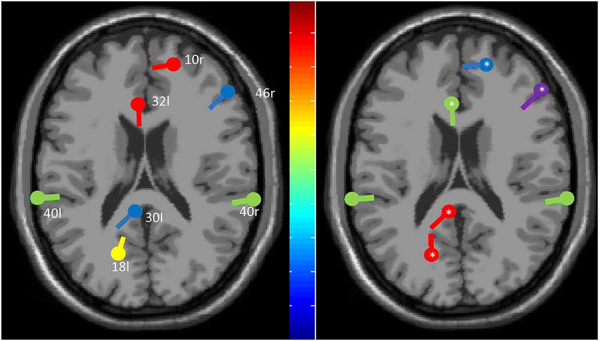 Frontiers | A Case of Psychogenic Myoclonus Responding to a Novel ...