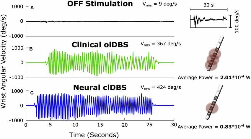 Frontiers | Perspective: Evolution of Control Variables and Policies for Closed-Loop Deep Brain ...