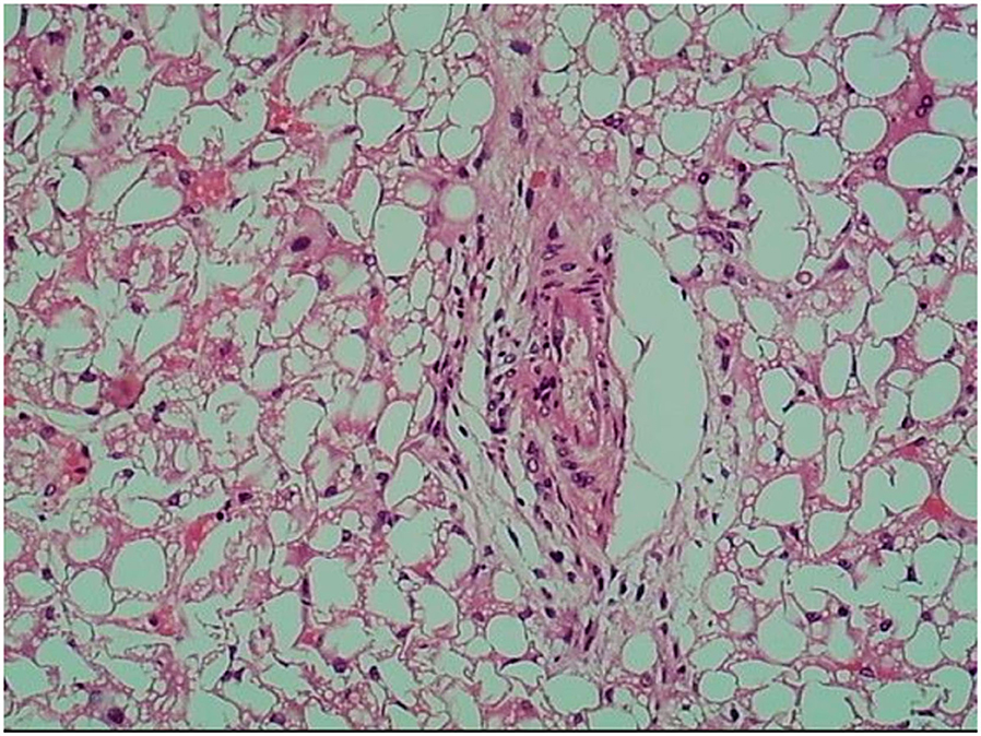 Frontiers | Late-Onset Carnitine–Acylcarnitine Translocase Deficiency ...