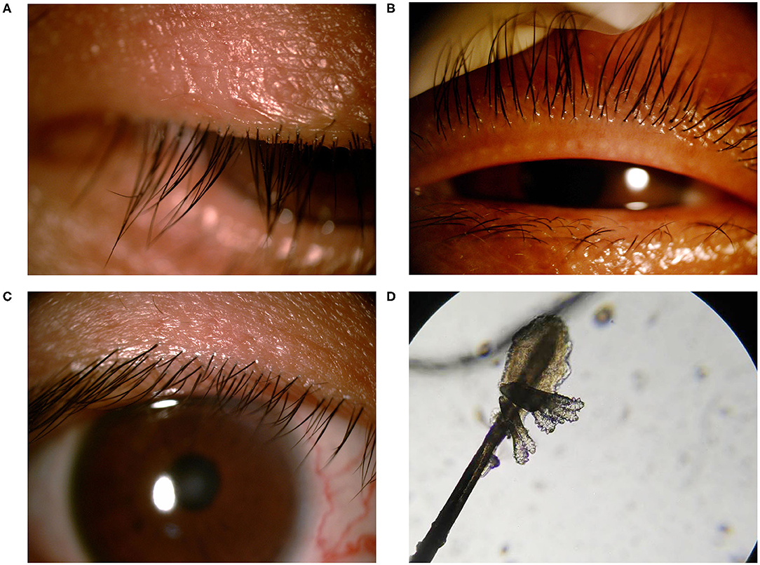 Frontiers | Association Between Demodex Infestation and Ocular Surface ...
