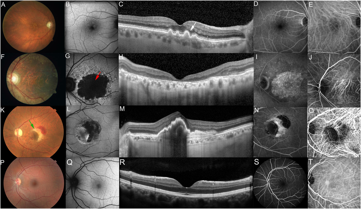 Frontiers | Age-Related Macular Degeneration Revisited: From Pathology and Cellular Stress to ...