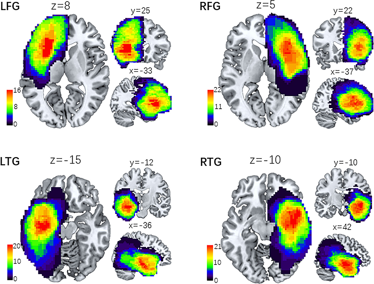 Frontiers | The Functional Reorganization of Language Network Modules ...