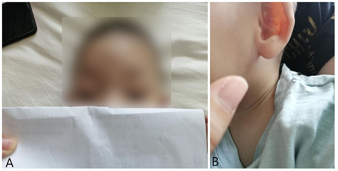 Frontiers | Case Report: A Case Report and Literature Review of 3p ...