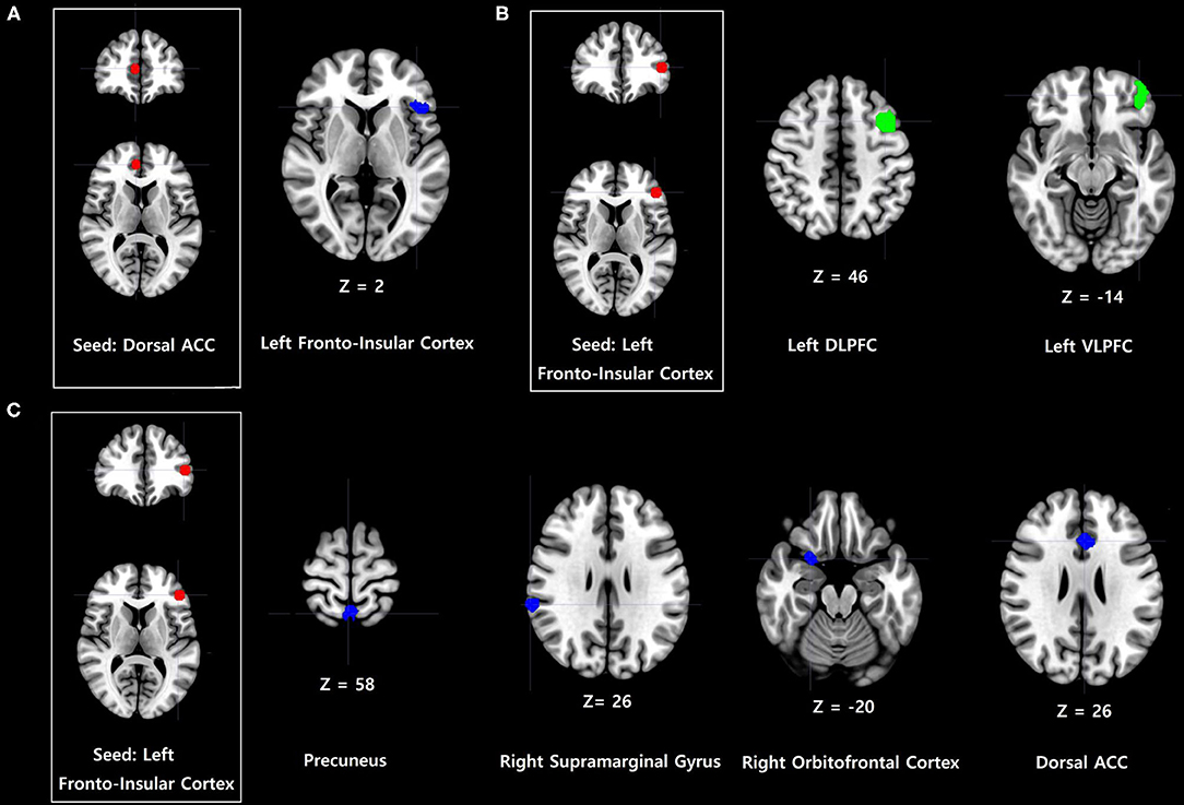 Frontiers | Altered Functional Connectivity of the Salience Network in ...