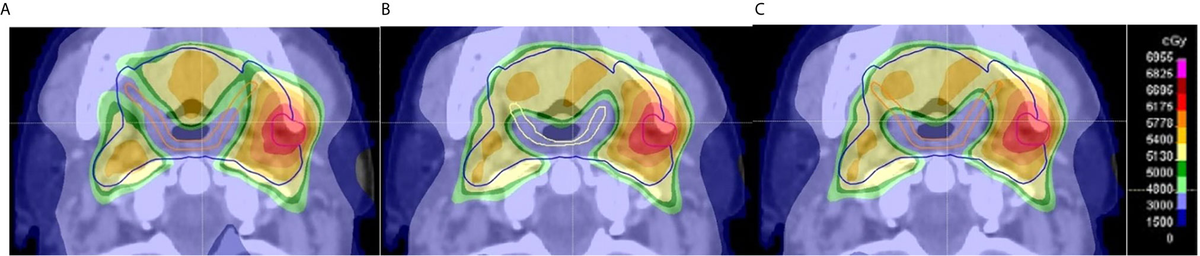 Frontiers | Inter-Observer Variation in Delineating the Pharyngeal ...