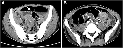 Frontiers 3d Laparoscopy Assisted Operation To Adult Intussusceptions