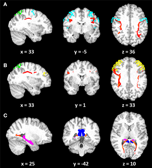 Frontiers | Developmental Topographical Disorientation With Concurrent ...