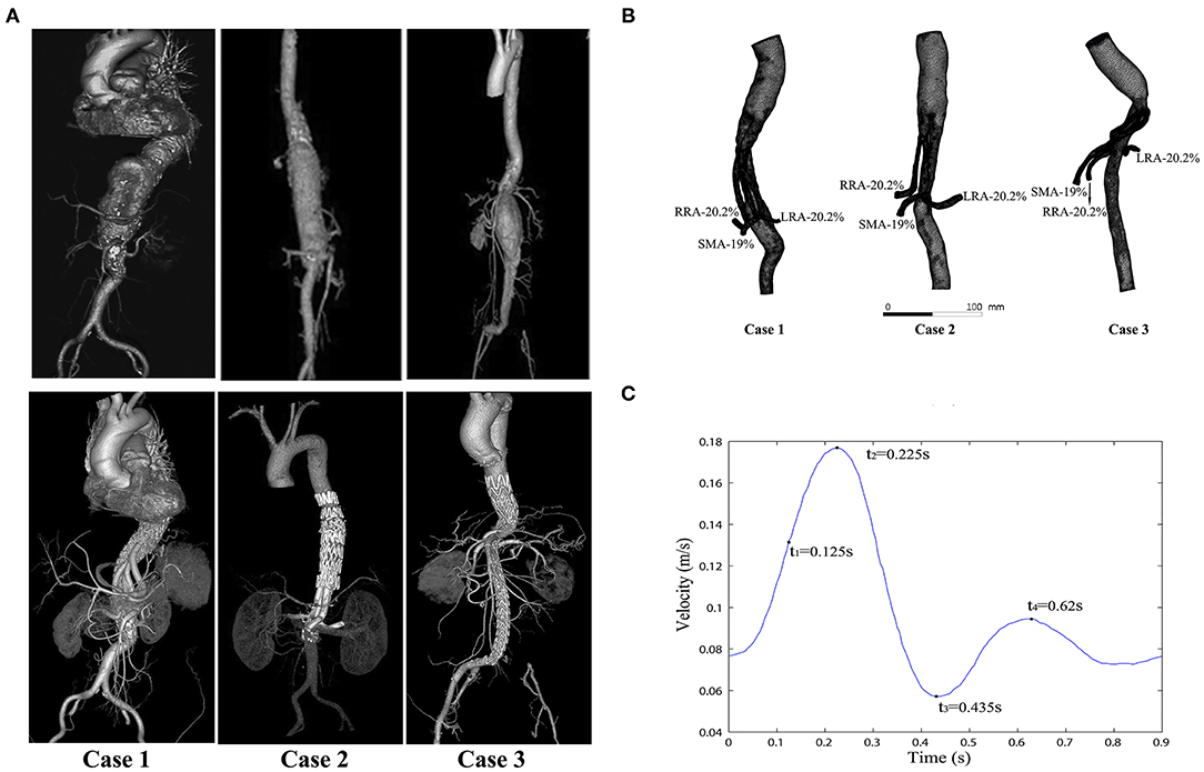Frontiers | Hemodynamic Parameters Predict In-stent Thrombosis After ...