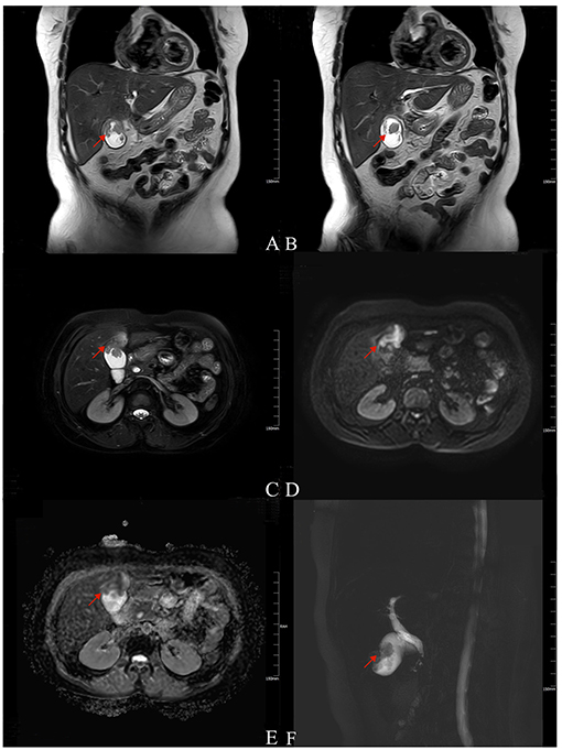 Frontiers | Attempt of Real-Time Near-Infrared Fluorescence Imaging ...