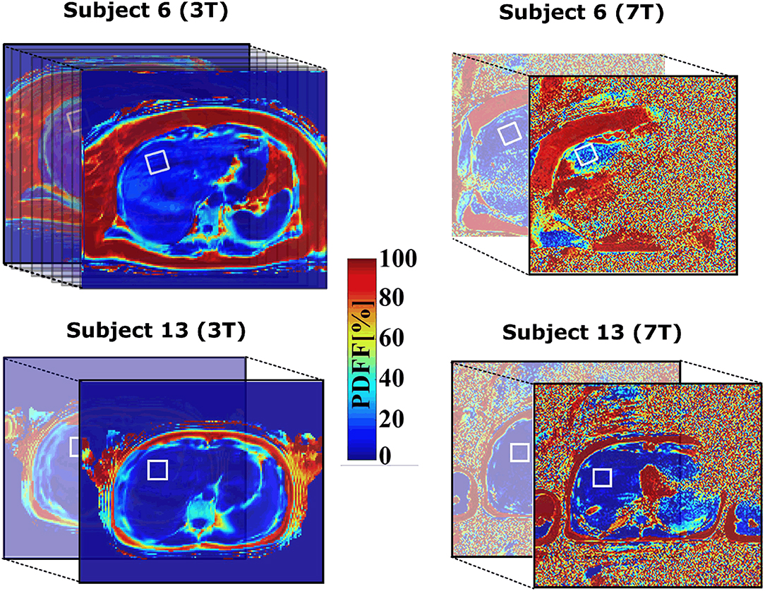 Frontiers | Feasibility of Hepatic Fat Quantification Using Proton Density Fat Fraction by Multi ...