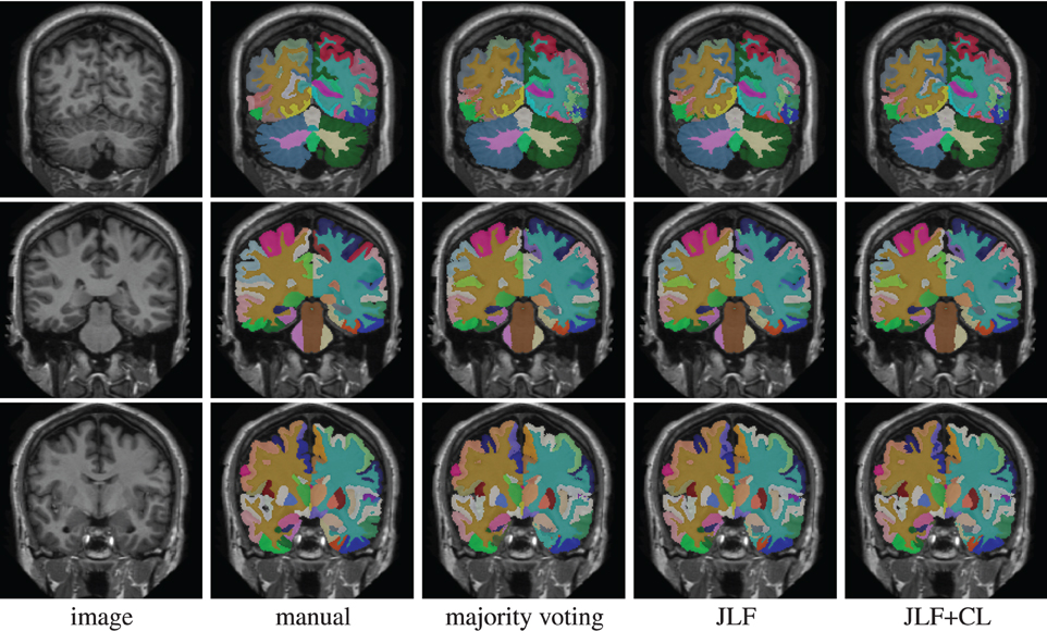 Frontiers | Multi-atlas segmentation with joint label fusion and corrective learning—an open ...