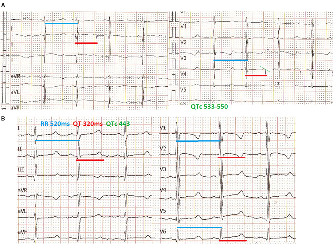 Frontiers | Mexiletine Treatment for Neonatal LQT3 Syndrome: Case ...
