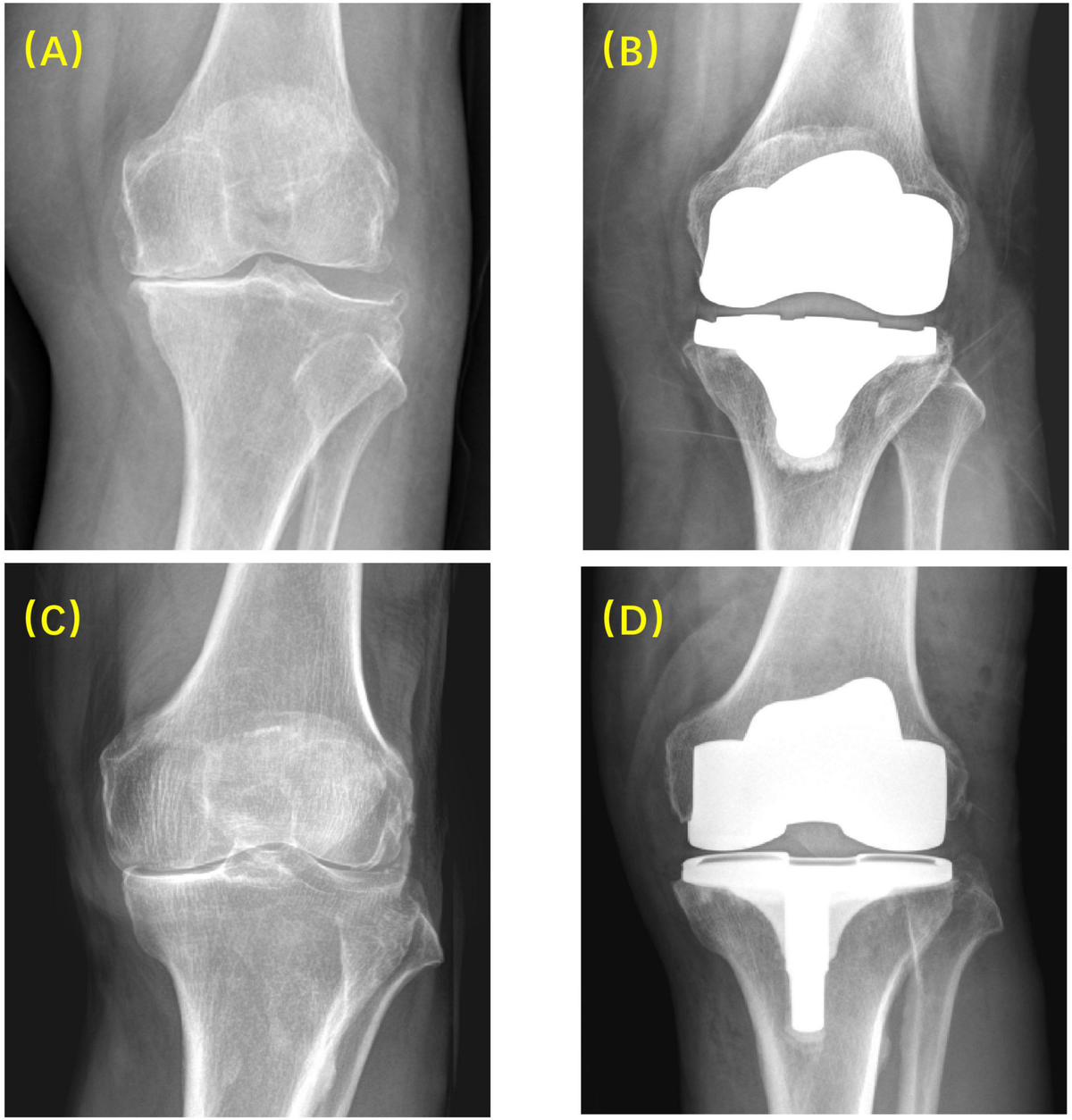 Frontiers | Loss of Knee Flexion and Femoral Rollback of the Medial ...