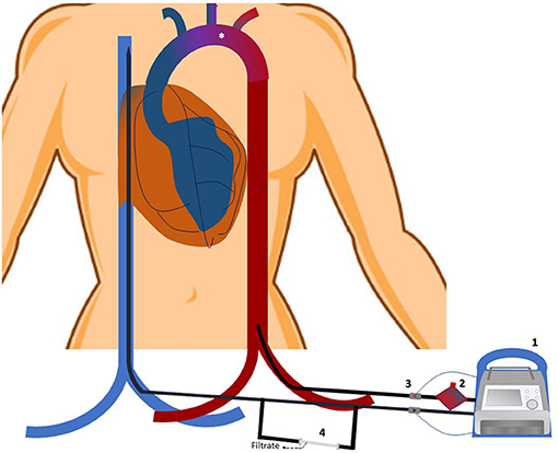 Frontiers | Overview of Veno-Arterial Extracorporeal Membrane ...