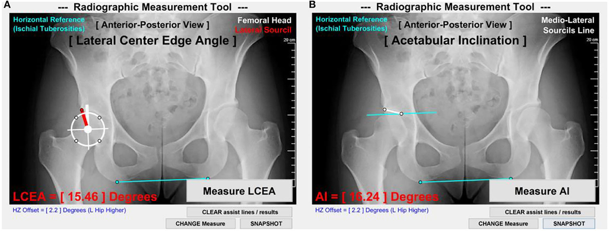 Frontiers | Acetabular Edge Loading During Gait Is Elevated by the ...