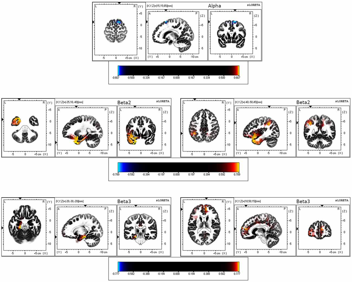 Frontiers | Anterior Cingulate Cortex Activity During Rest Is Related to Alterations in Pain ...